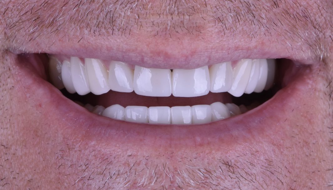 Pure Smile Cabo: Unleash Your Perfect Smile | See Results!